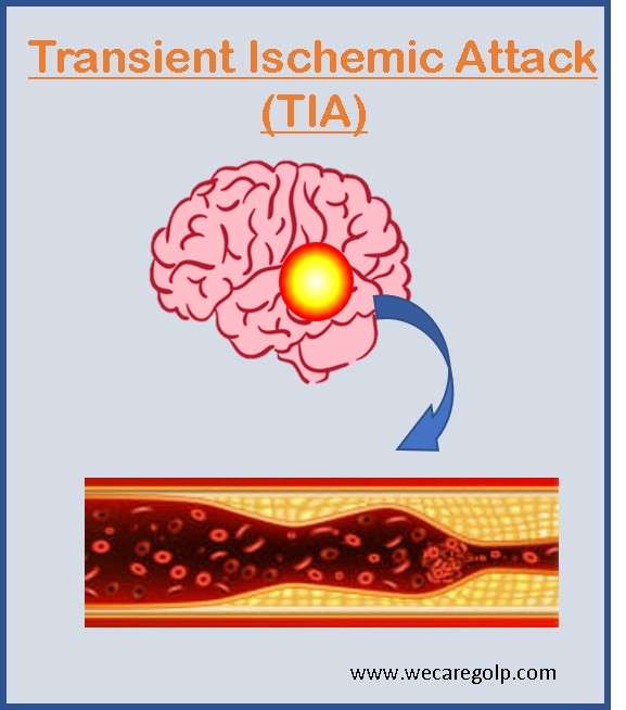 Stroke Types Symptoms Treatment Complications We Care Stroke Types Symptoms Treatment Complications We Care