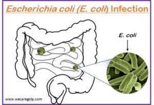 Escherichia coli Infection - We Care