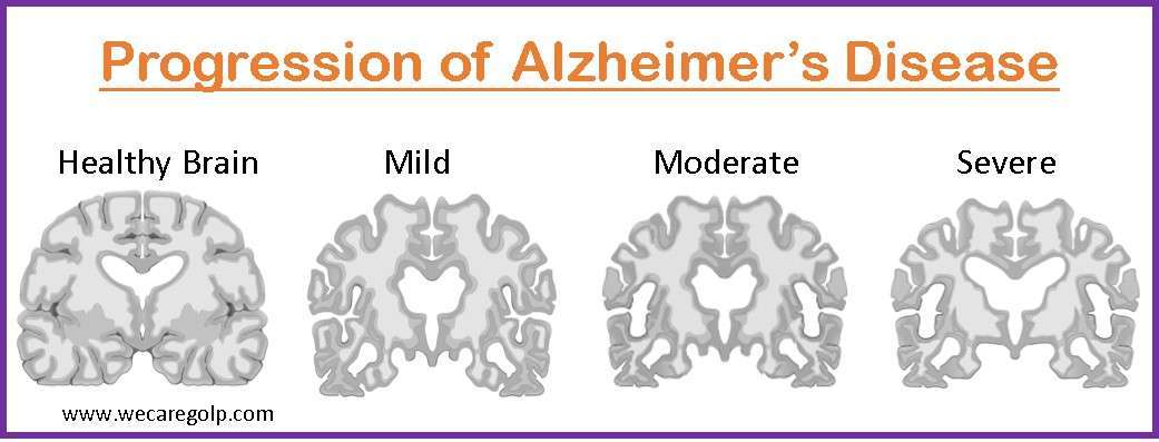 Alzheimer's Disease - We Care
