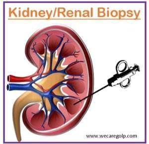 Kidney Biopsy - We Care